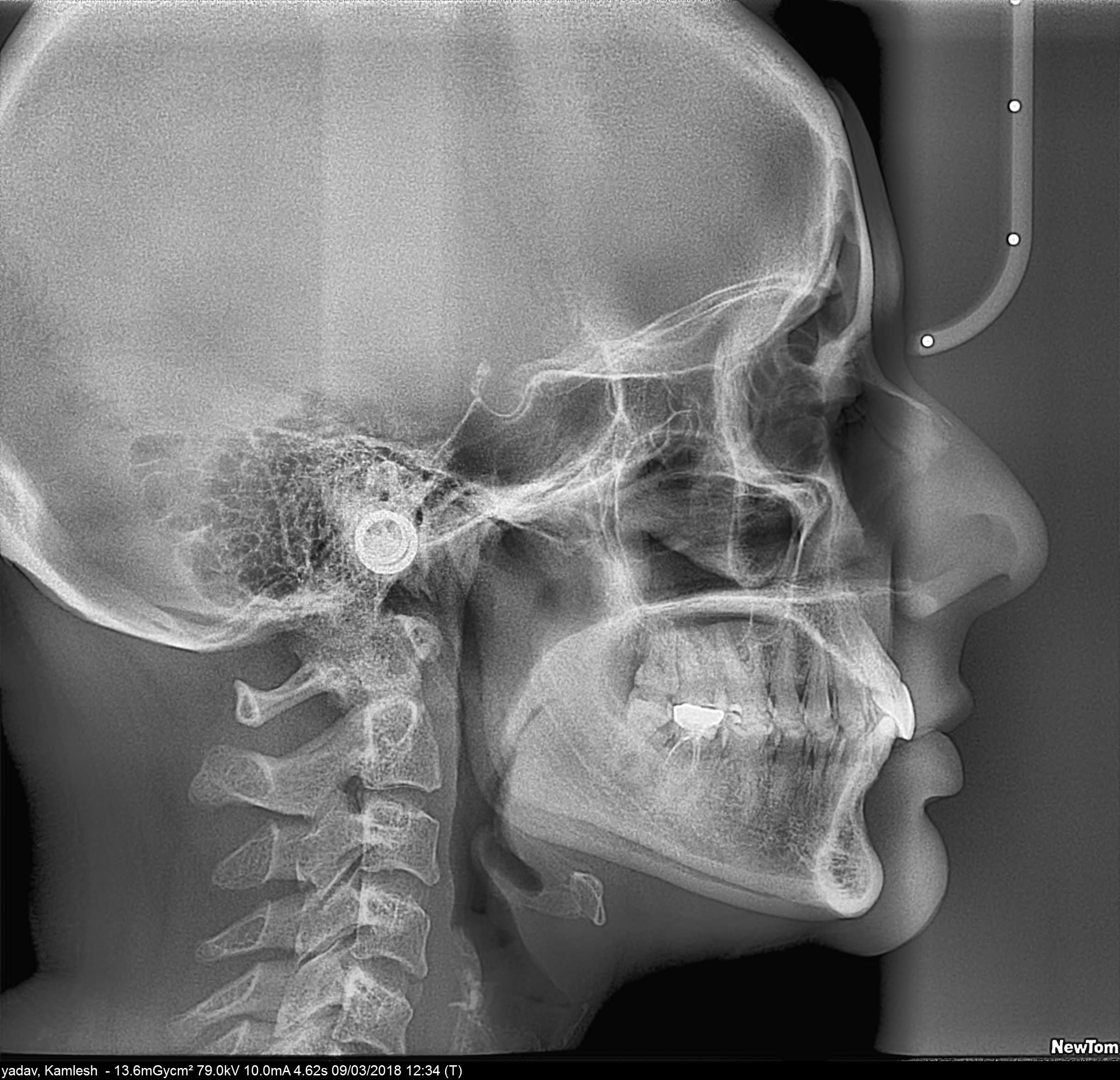 Lateral Ceph Radiodent Dental And Maxillofacial Imaging Lateral Ceph Radiodent Dental And Maxillofacial Imaging